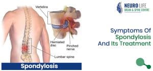 Spondylosis Symptoms Causes & Treatment